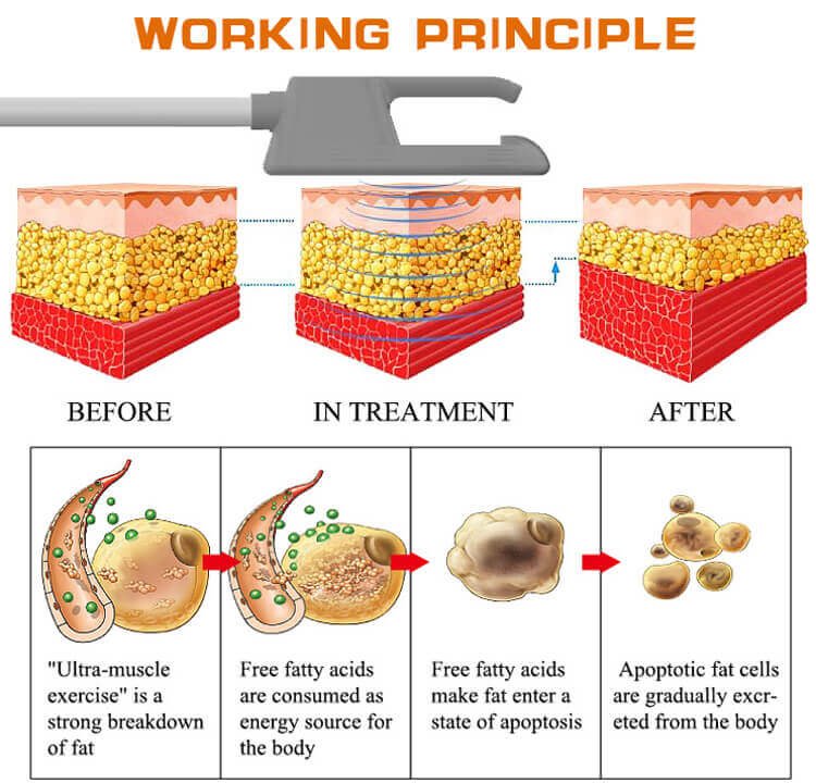 Everything You Need to Know About Emsculpt - Mico Aes
