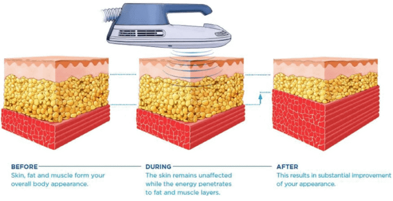 Explore the World of Emsculpt Machines: A Comprehensive Guide to Body ...