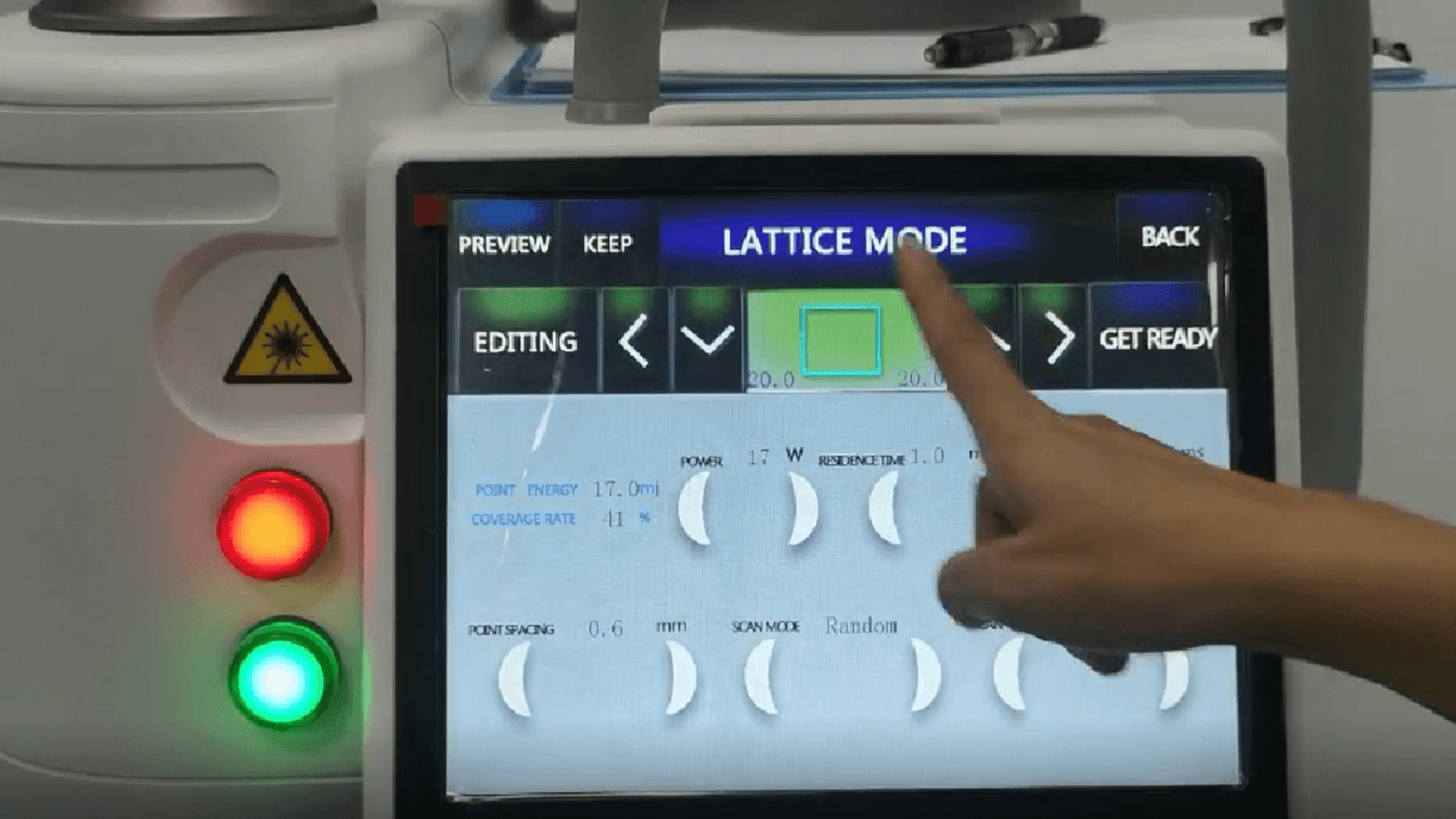 Co2 Fractional Laser Treatment Parameters for Stretch Marks