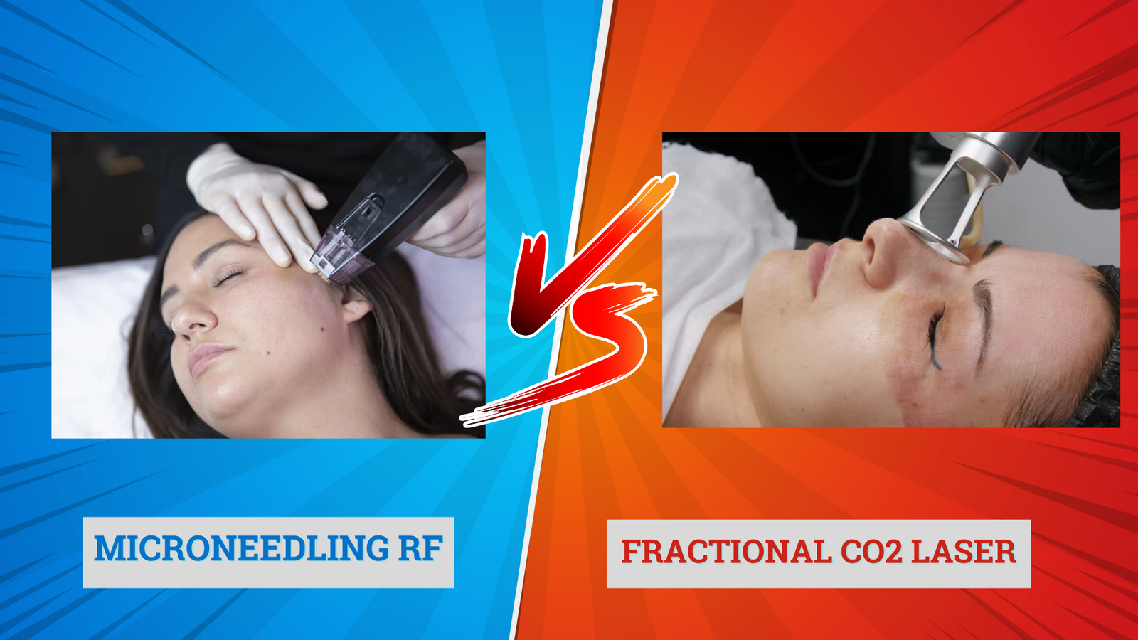 CO2 Fractional Laser vs. RF Microneedling: Which Skin Treatment Is ...