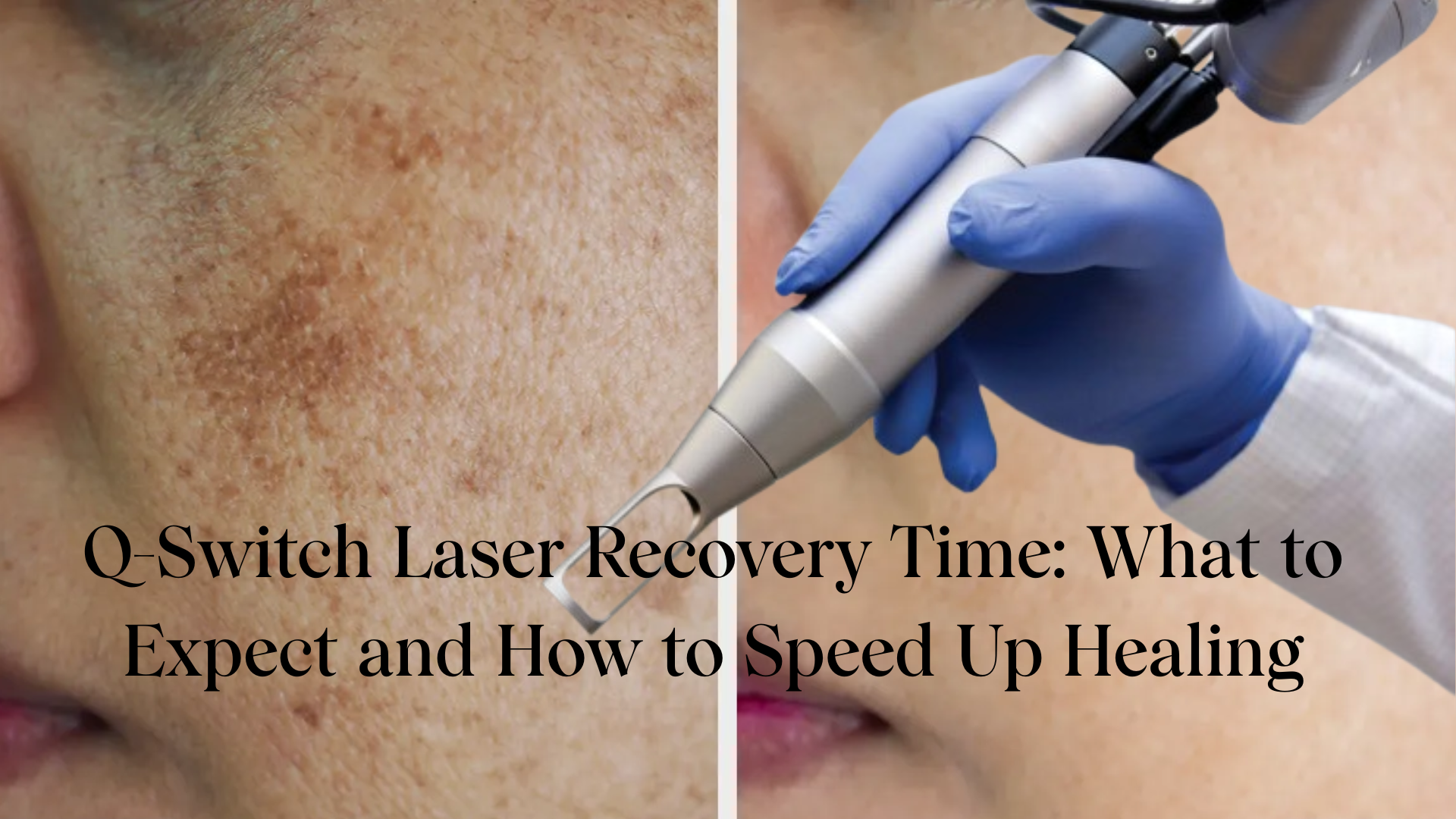 Q-Switch Laser Recovery Time: What to Expect and How to Speed Up ...