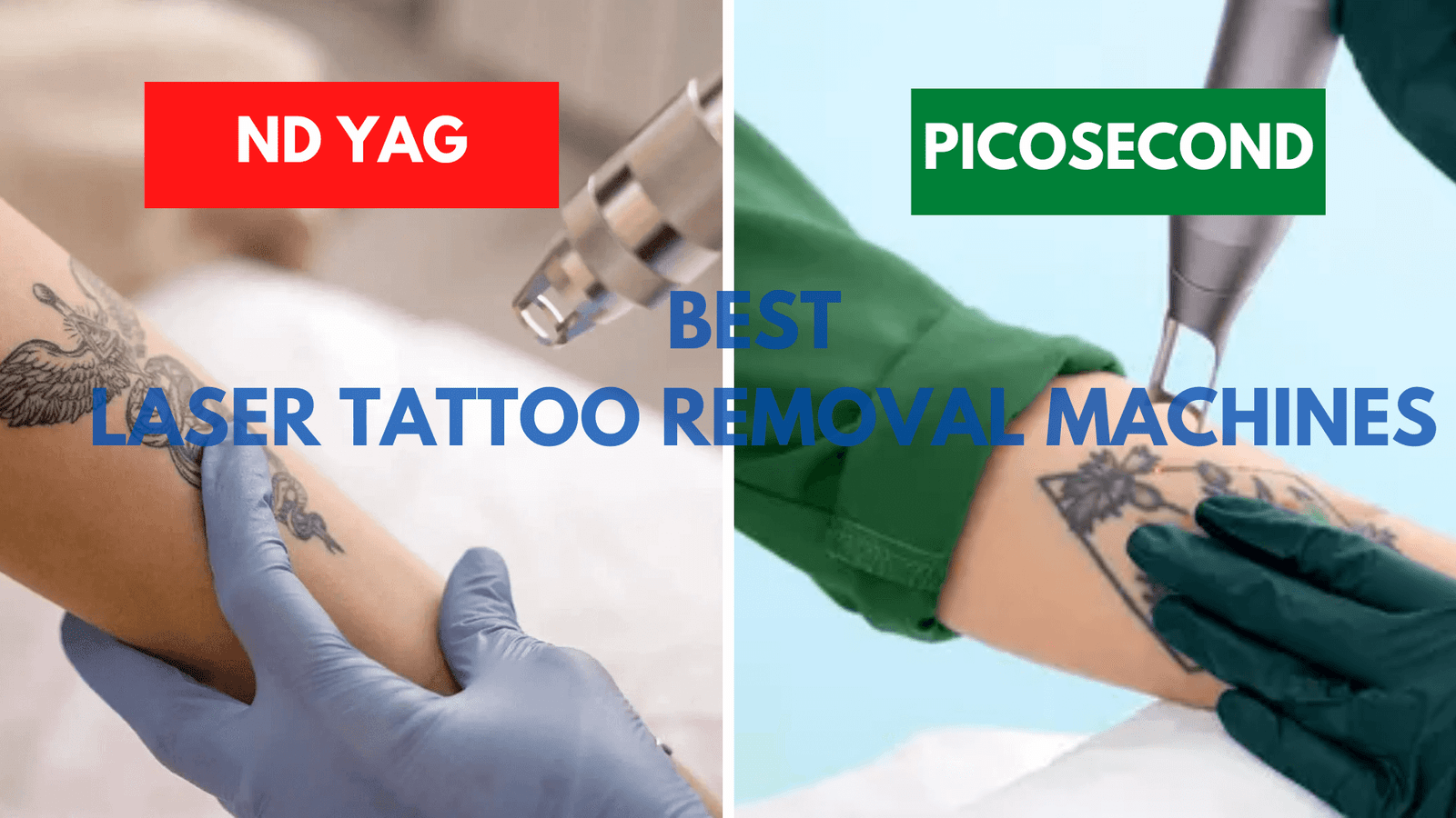 How Different Laser Technologies Impact Tattoo Removal Results and Costs